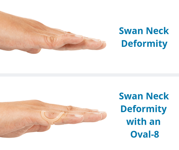 Treating Swan Neck Deformity With Oval 8 Finger Splints